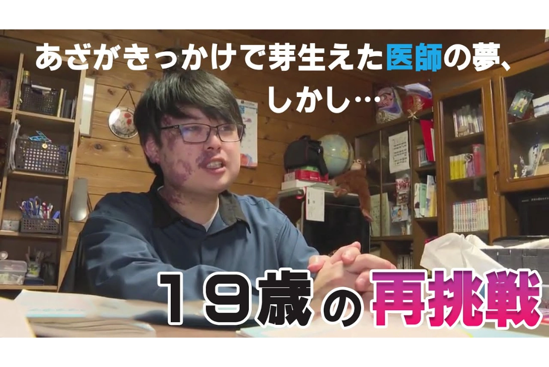 【続編】あざと生きる 苦悩と決断 19歳の再挑戦 - YBC 山形放送